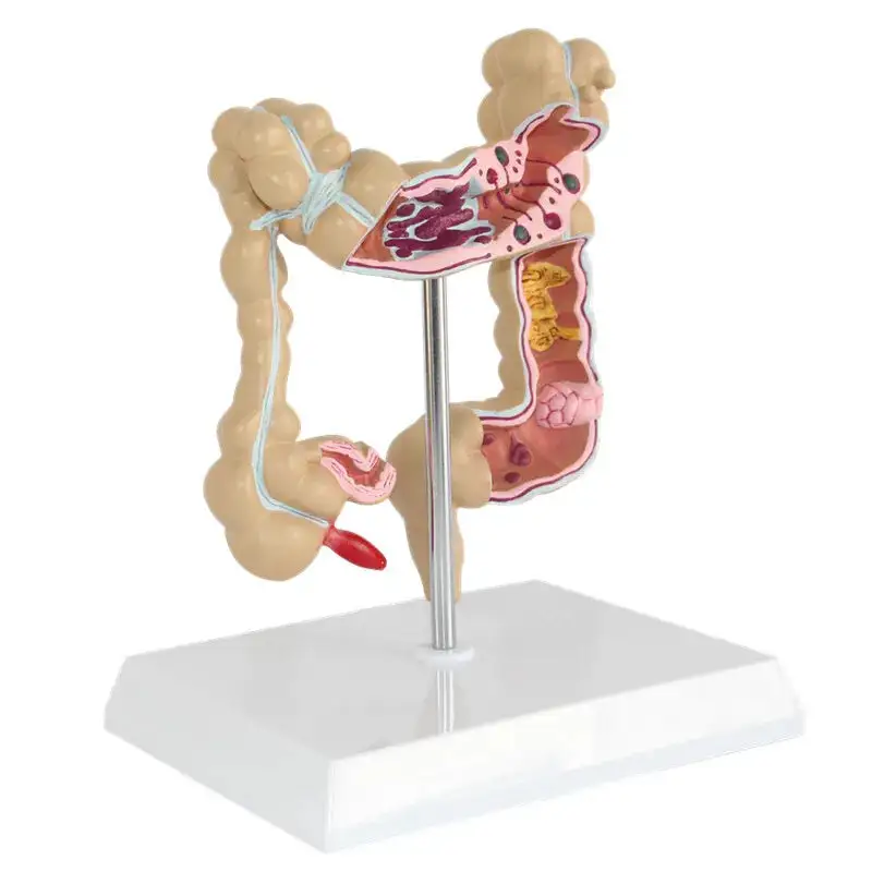 Anatomical Human Colorectal Lesion Model Anatomy Colon Diseases ...